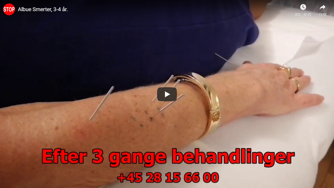 Albue smerter – En 48-årige kvinde, albue smerter, 3-4 år | Stop ...