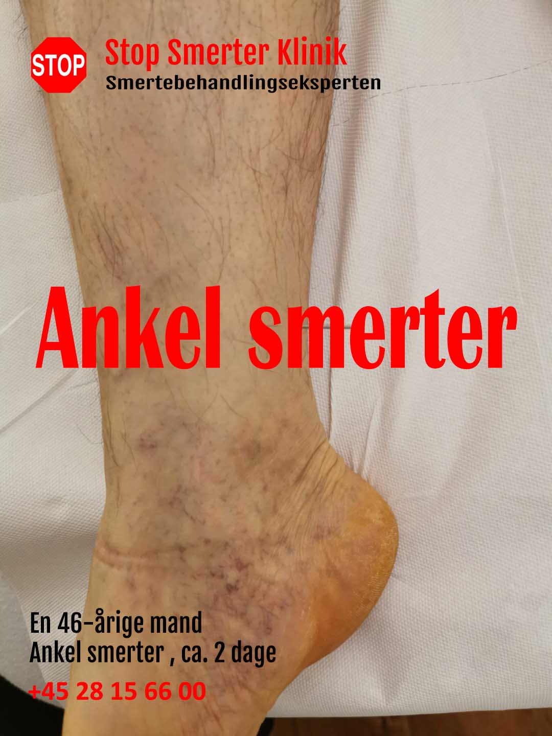 Ankel smerter – En 46-årige mand, ca. 2 dage – Stop Smerter Akupunktur